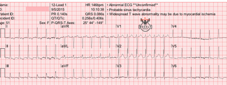 Differential Diagnoses: the main three things that cause narrow complex ...