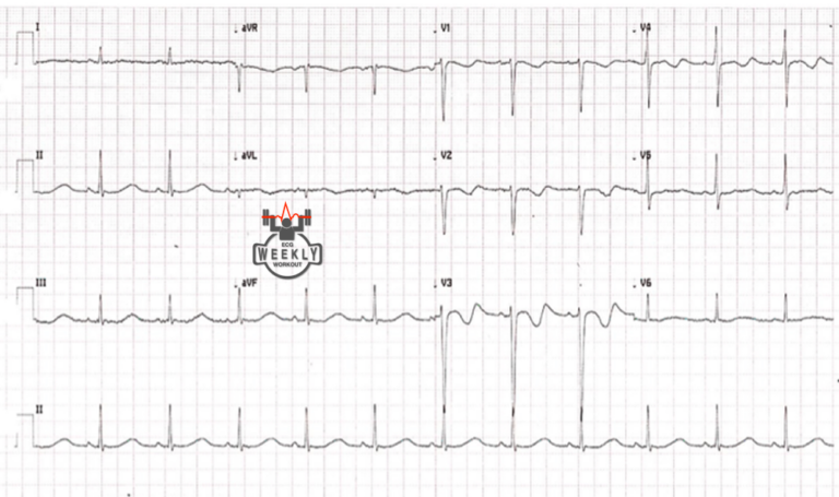 Prolonged QTC interval from severe hypokalemia – ECG Weekly