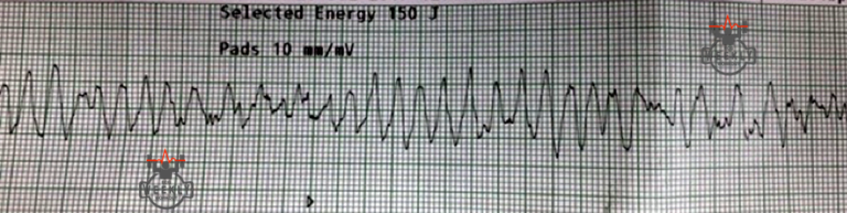 STAT ECG Diagnoses: when to avoid amiodarone – ECG Weekly