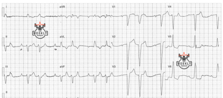 Rhythm Interpretation: watch out for pokey T waves – ECG Weekly