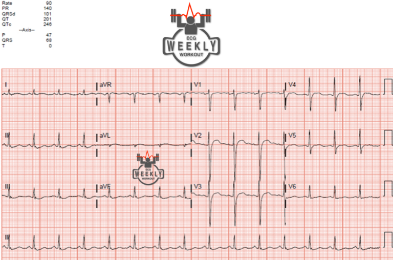 Differential Diagnoses: how hypercalcemia mimics STEMI – ECG Weekly