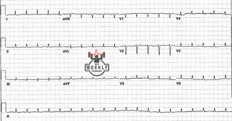 ECG Basics & Fundamentals: electrical alternans is present in less than ...