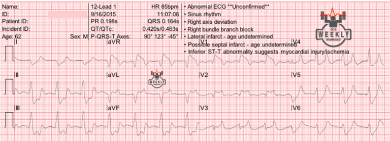Literature Review: aVR – The forgotten 12th lead – ECG Weekly