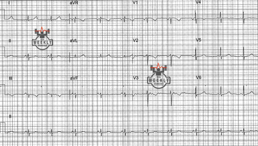 STAT ECG Diagnoses: epsilon waves in patient with syncope – ECG Weekly