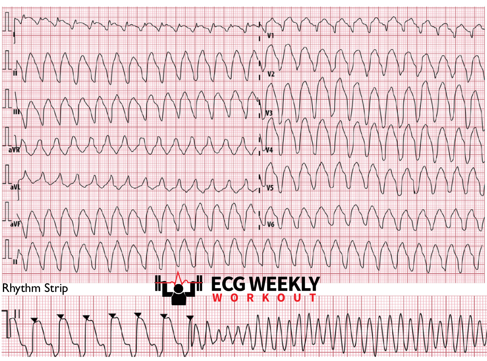STAT ECG Diagnoses: ventricular fibrillation after synchronized ...