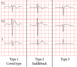 Brugada Types – ECG Weekly