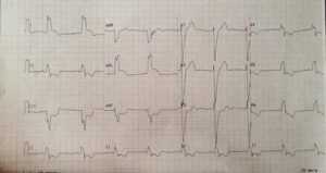 Case 306 – ECG Weekly