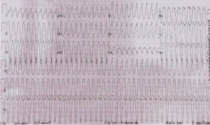 Case 320 – ECG Weekly