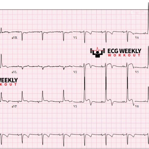 Normal variant patterns – ECG Weekly