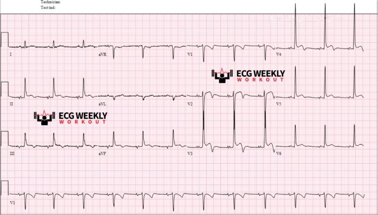 Do these biphasic T waves and ST segment abnormalities suggest acute coronary occlusion MI ...