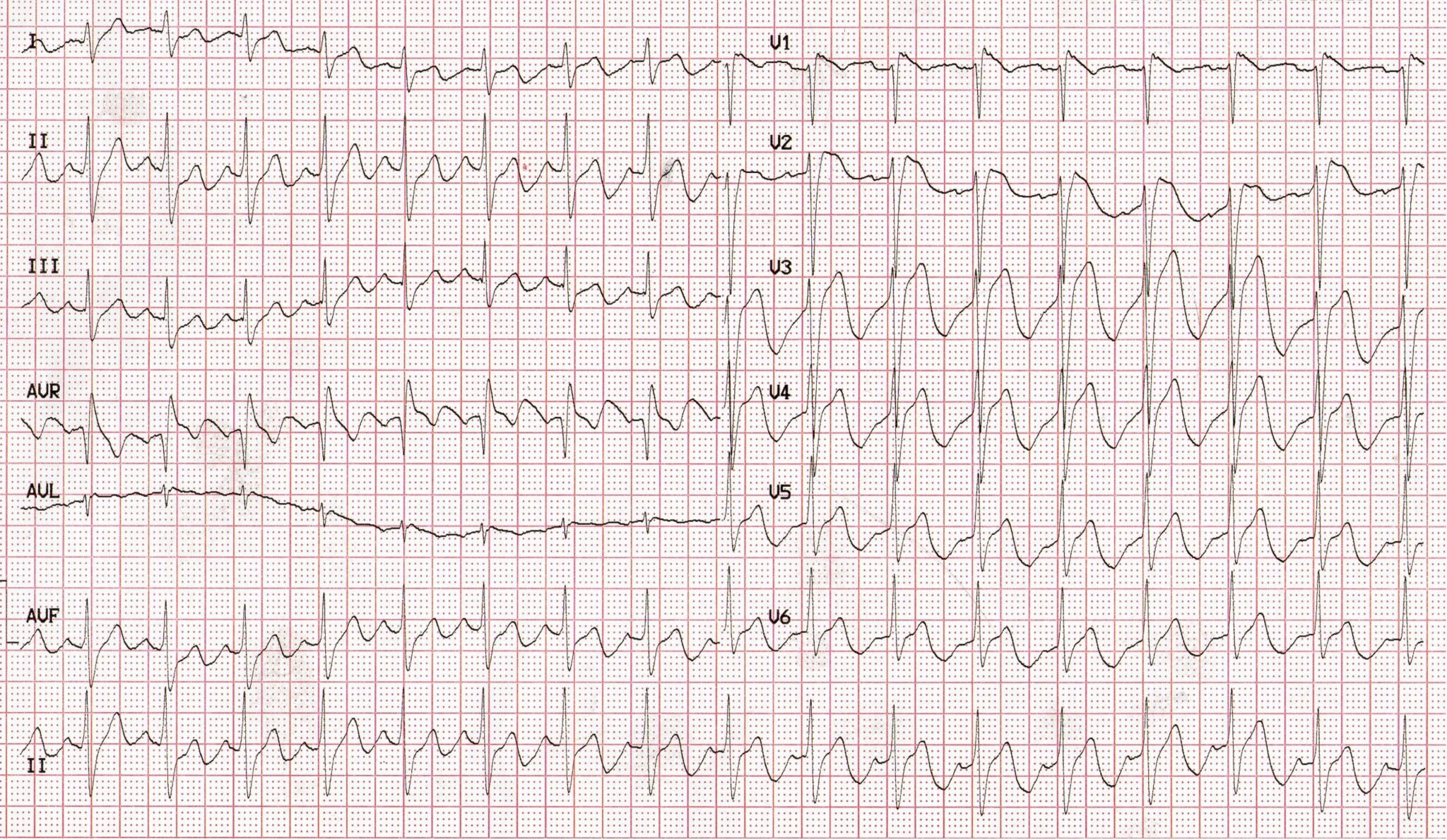 Literature Review: ST segment elevation after syncope and cardiac arrest – ECG Weekly