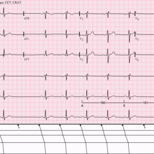 Sinoatrial Exit Block – ECG Weekly
