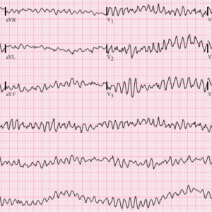 Ventricular fibrillation – ECG Weekly