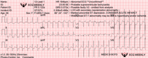 ECG Weekly – Mastering ECG interpretation to save and improve more lives.