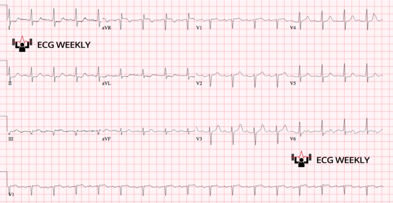 ECG Weekly – Mastering ECG interpretation to save and improve more lives.