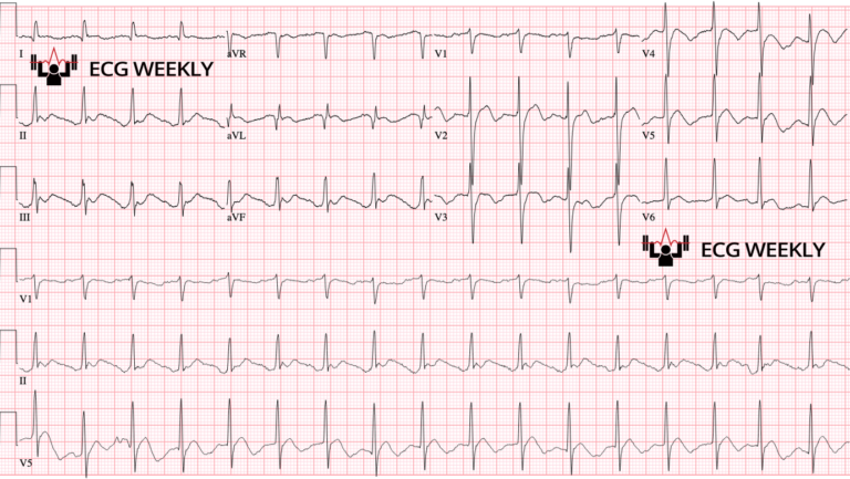 Literature Review: Resolution of ST elevation on serial ECGs in post ...