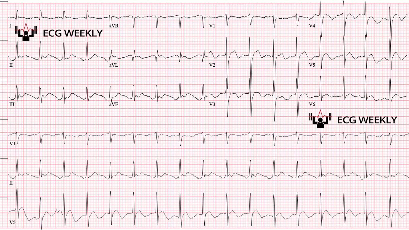 ECG Weekly – Mastering ECG interpretation to save and improve more lives.