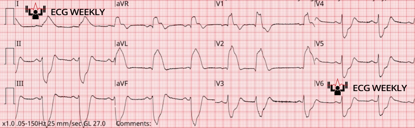 ECG Weekly – Mastering ECG interpretation to save and improve more lives.