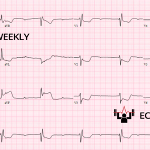 Complete Heart Block – ECG Weekly
