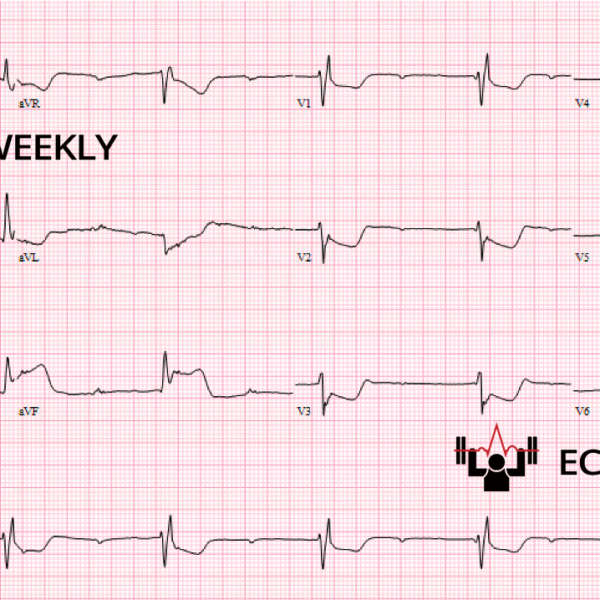 Complete Heart Block – ECG Weekly