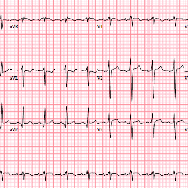 Pulmonary Embolism – ECG Weekly