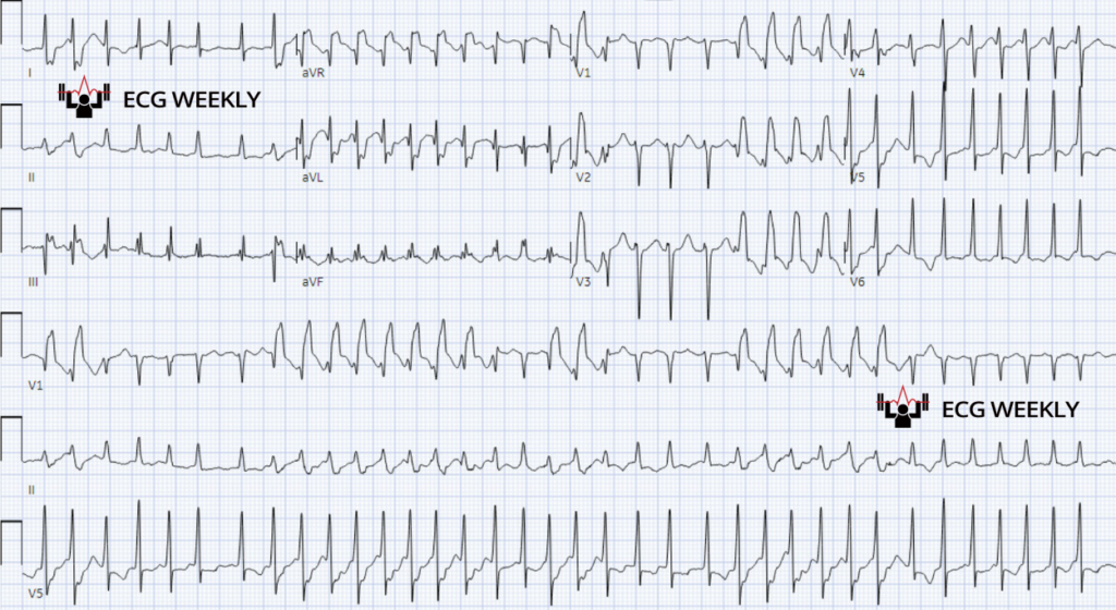 ECG Weekly – Mastering ECG interpretation to save and improve more lives.
