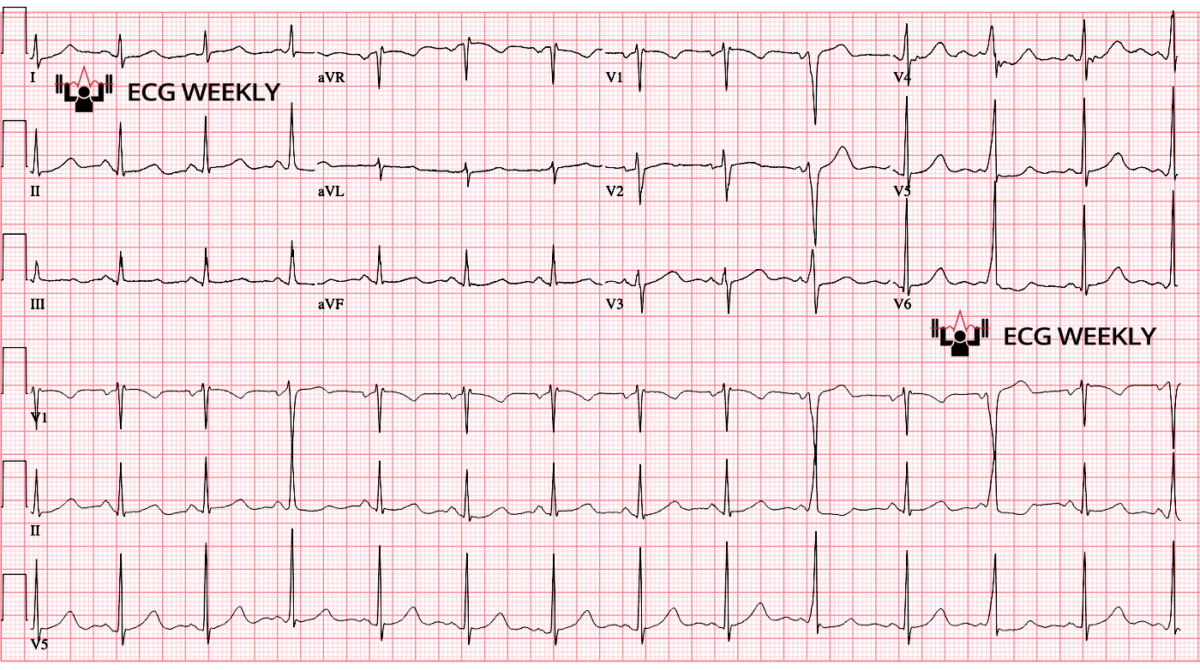 Post Cardioversion ECG Of SVT In Patient With Palpitations And Near Post Cardioversion ECG Of SVT In Patient With Palpitations And Near