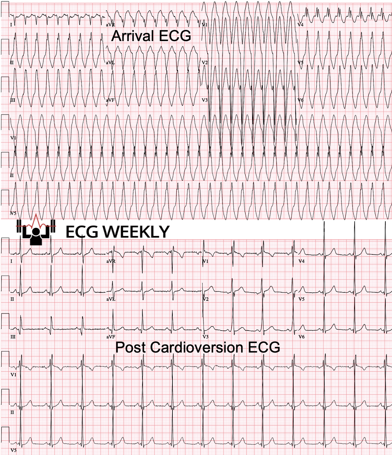Wolff-Parkinson-White (WPW) Syndrome with Supraventricular Tachycardia ...