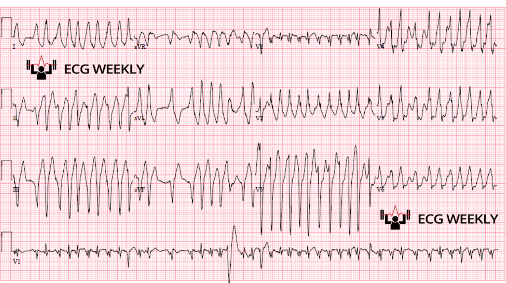 ECG Weekly – Mastering ECG interpretation to save and improve more lives.