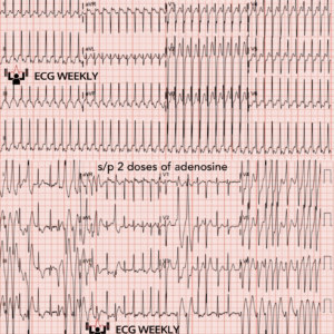 Atrial Fibrillation with WPW – ECG Weekly