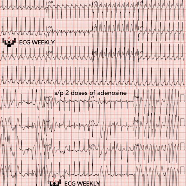 Polymorphic Ventricular Tachycardia – ECG Weekly