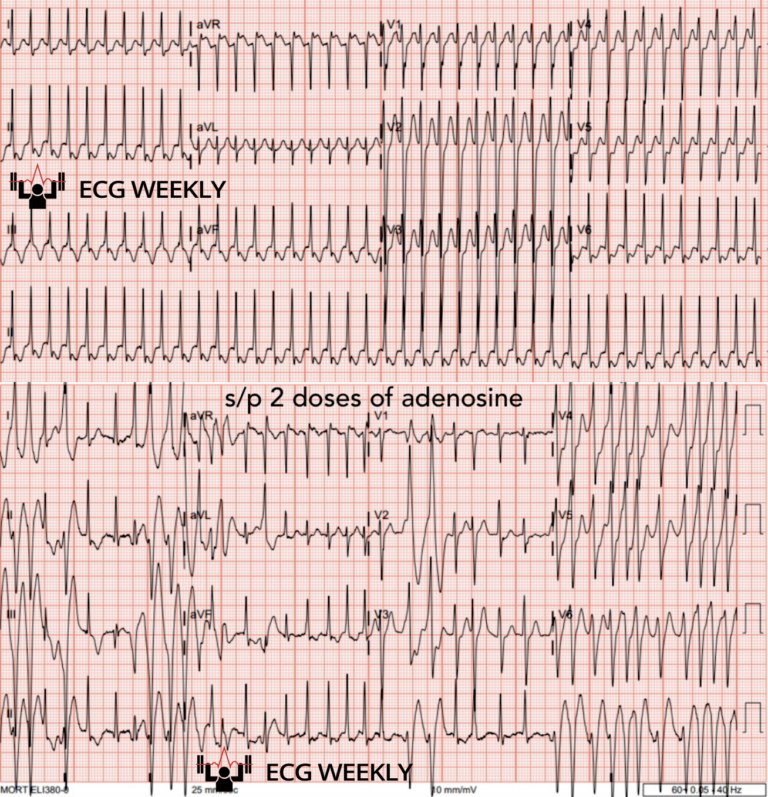 ECG Weekly – Mastering ECG interpretation to save and improve more lives.