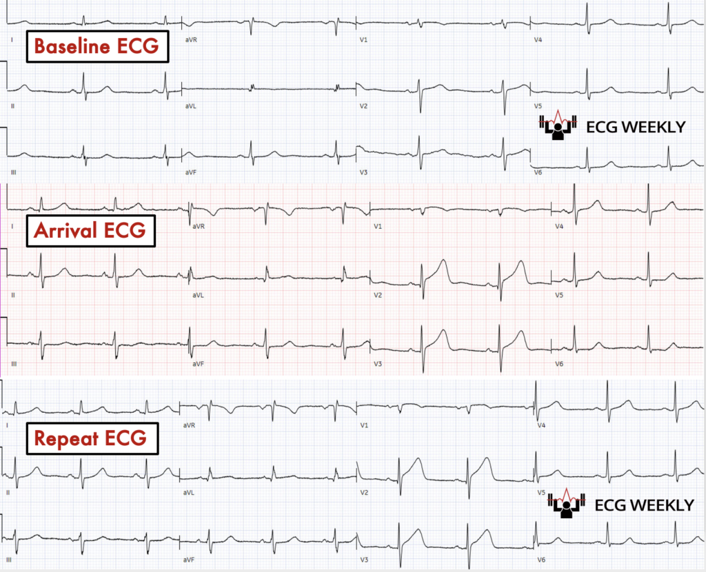 ECG Weekly – Mastering ECG interpretation to save and improve more lives.