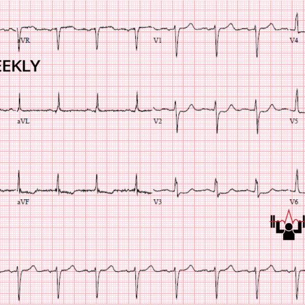 STEMI Equivalent – ECG Weekly