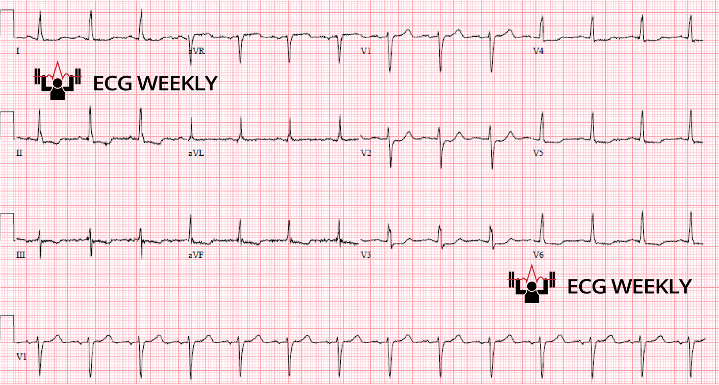 Concerning chest pain with ST segment depression in the anteroseptal ...