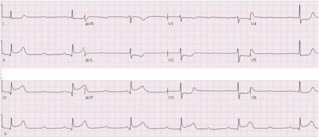 2024 ECG Competition Answers (Part 1/2) – ECG Weekly