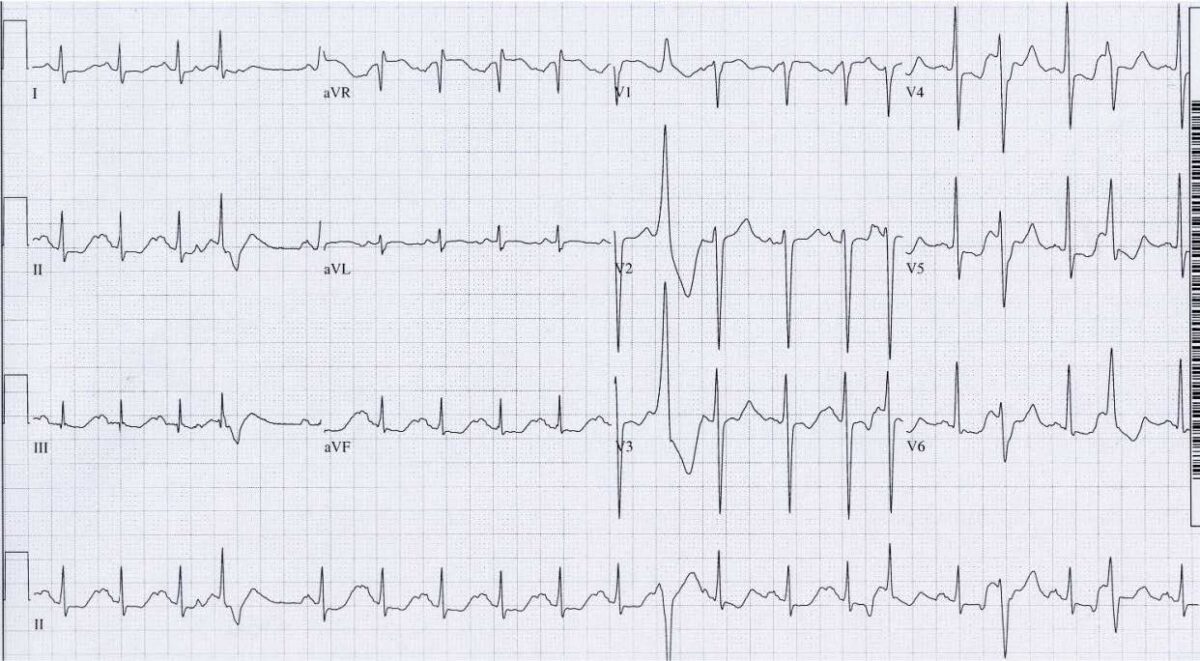 2024 ECG Competition Answers (Part 2/2) – ECG Weekly