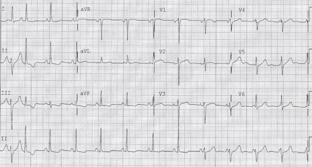 2024 ECG Competition Answers (Part 2/2) – ECG Weekly