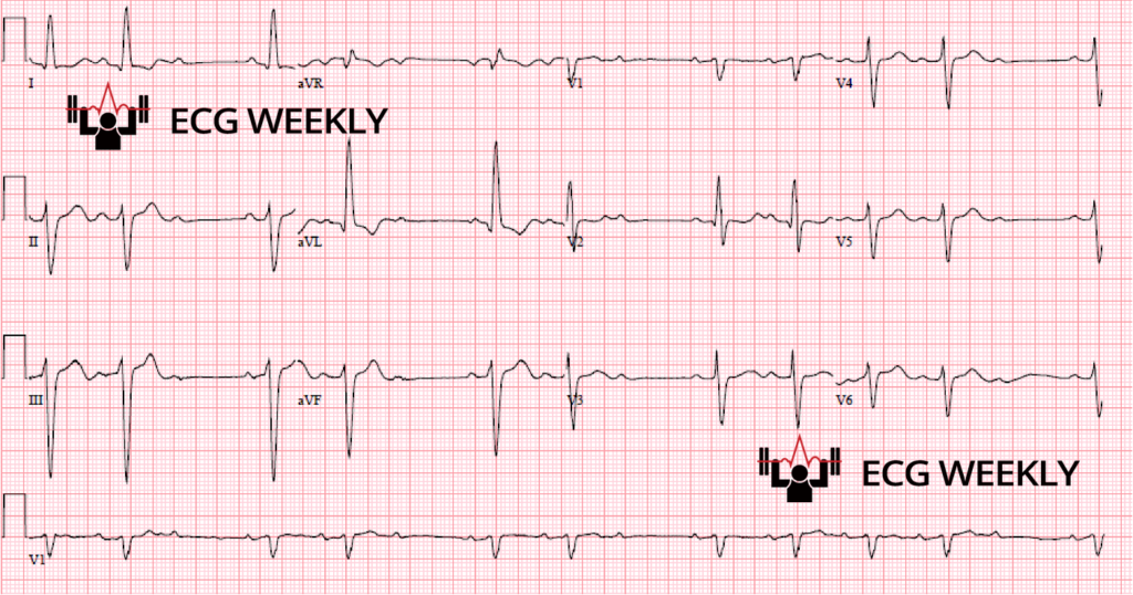 Key Points to Note About Mobitz I & Mobitz II – ECG Weekly