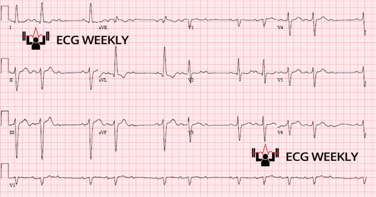 ECG Weekly – Mastering ECG interpretation to save and improve more lives.