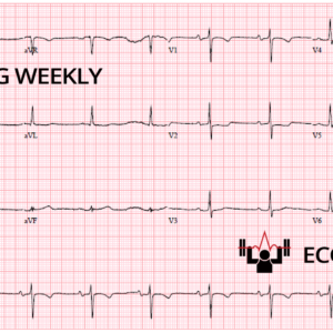 STEMI equivalent – ECG Weekly