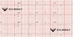 Key Points to Note About Complete Heart Block – ECG Weekly