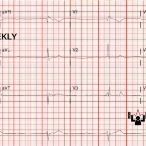 Complete Heart Block – ECG Weekly
