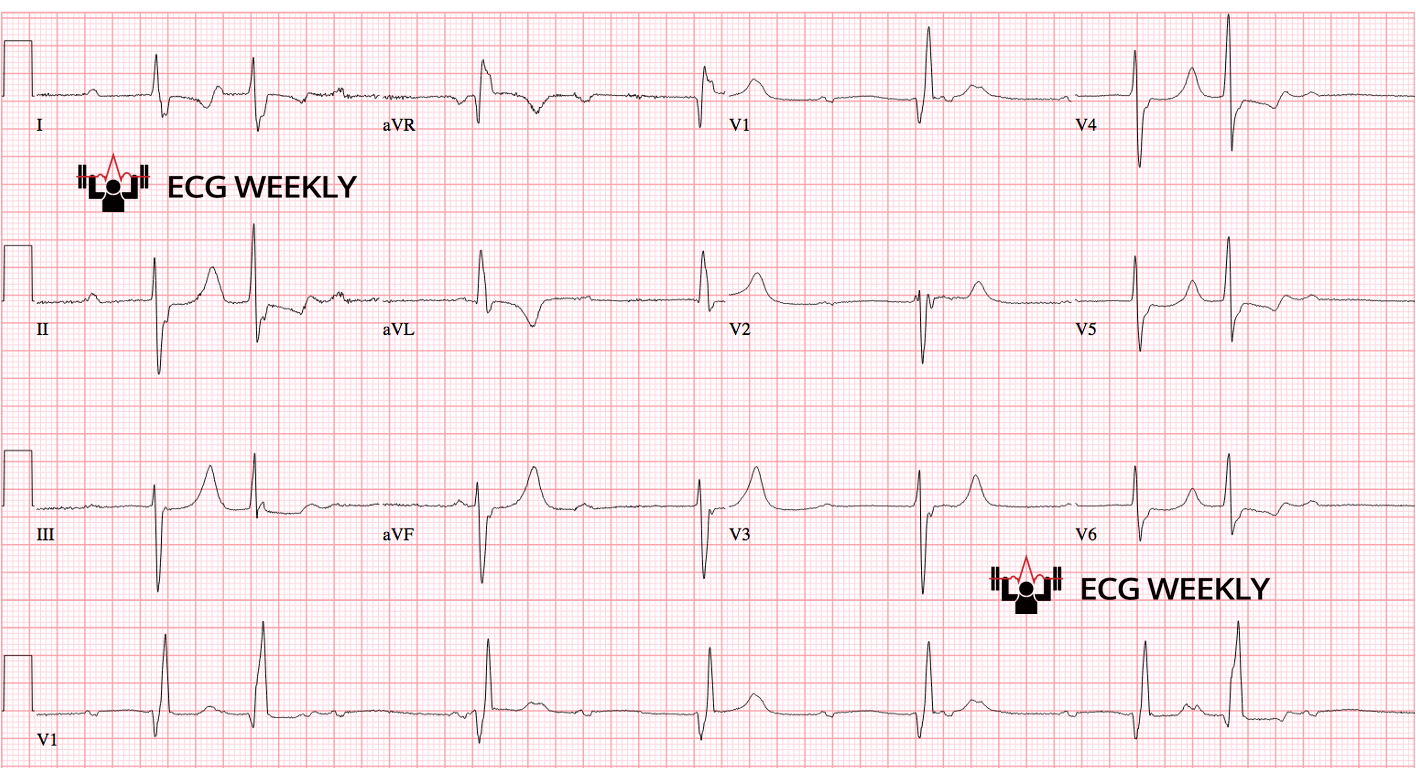 Distinction Between AV Dissociation and Complete Heart Block – ECG Weekly
