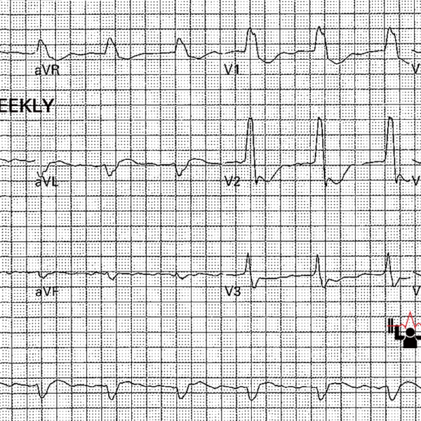 Digoxin toxicity – ECG Weekly