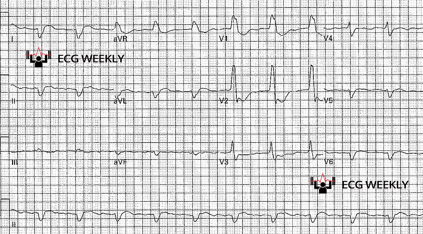 ECG Weekly – Mastering ECG Interpretation To Save And Improve More Lives