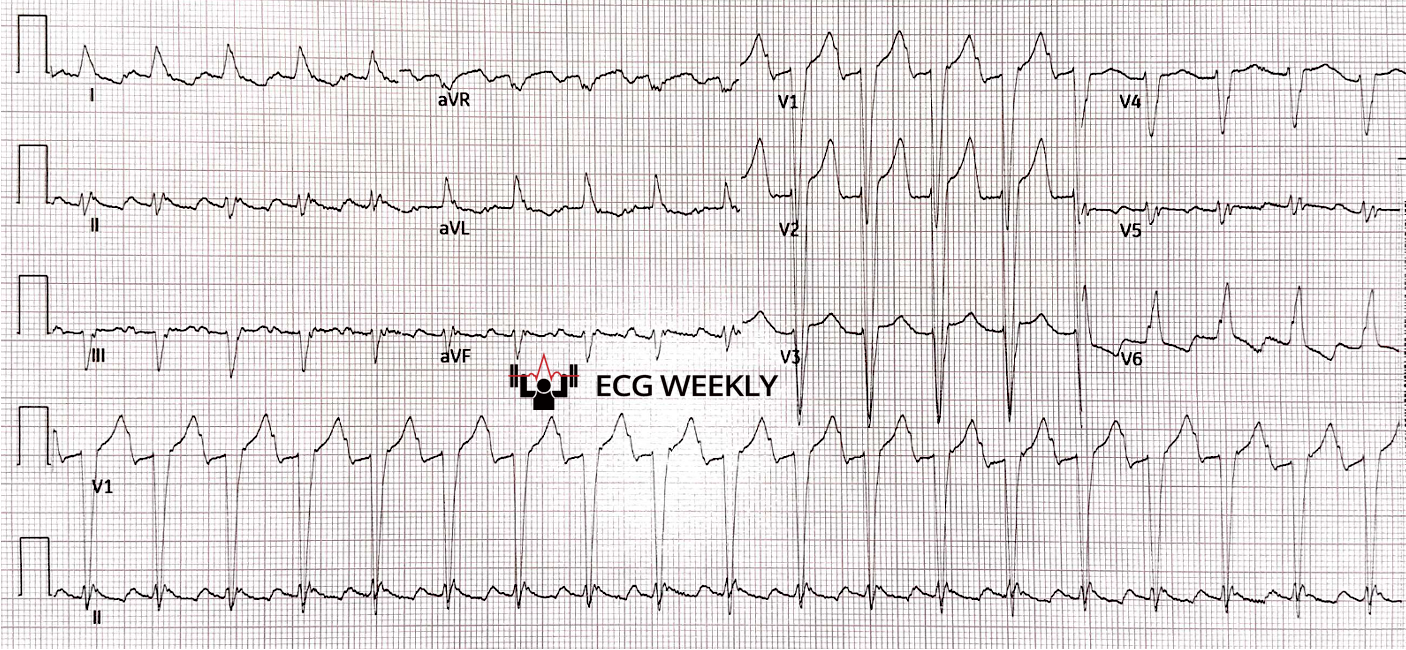ECG Weekly – Mastering ECG Interpretation To Save And Improve More Lives