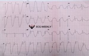 When One Lead Stands Alone: Deciphering Bizarre ECG Abnormalities – ECG Weekly
