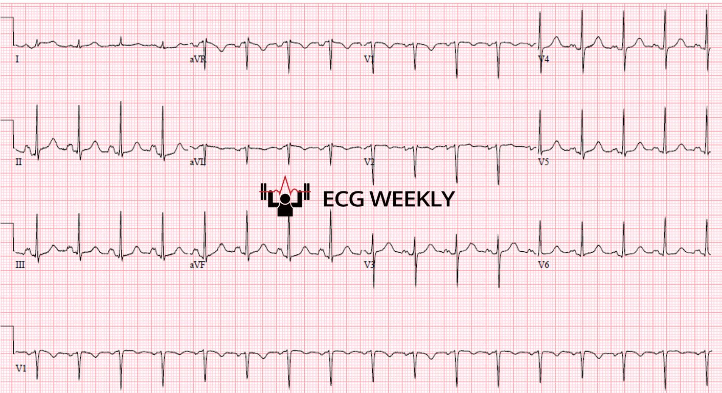 2024 UMMC Cases (Part II) – ECG Weekly