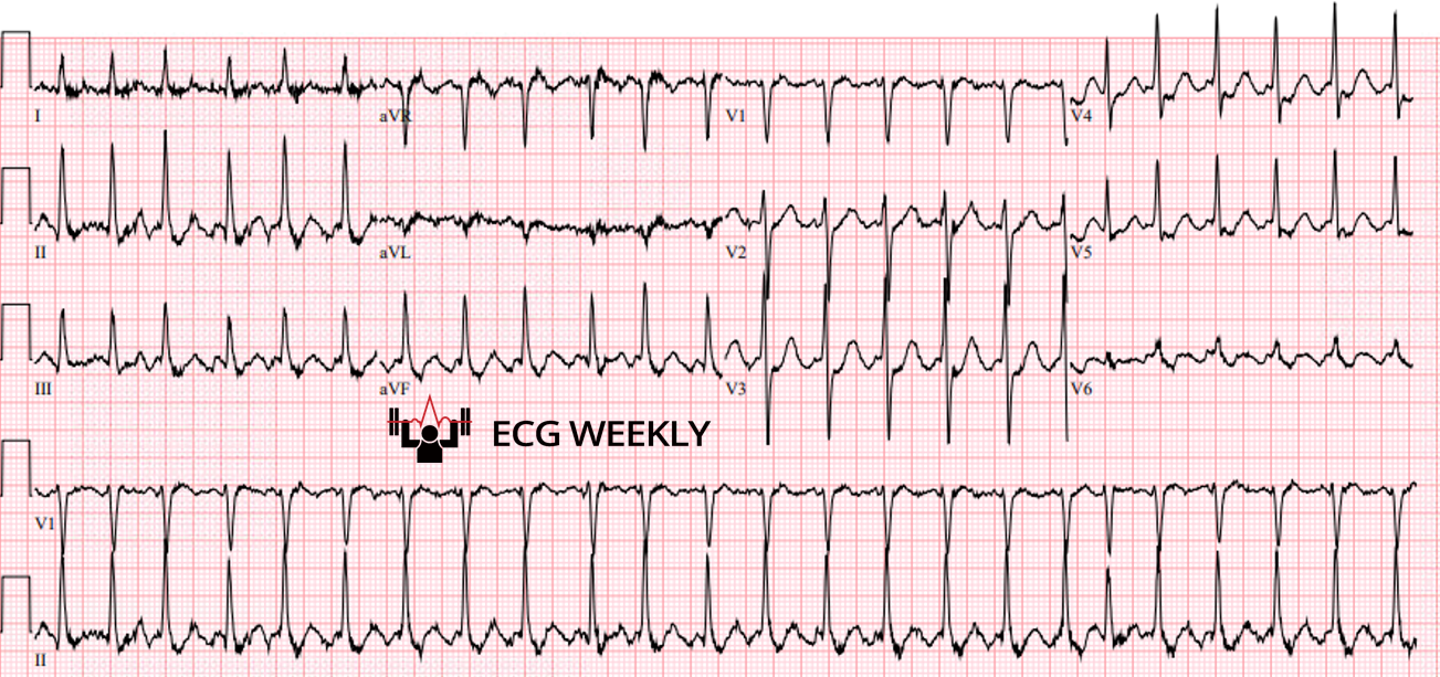 Recent UMMC Cases (Part III) – ECG Weekly